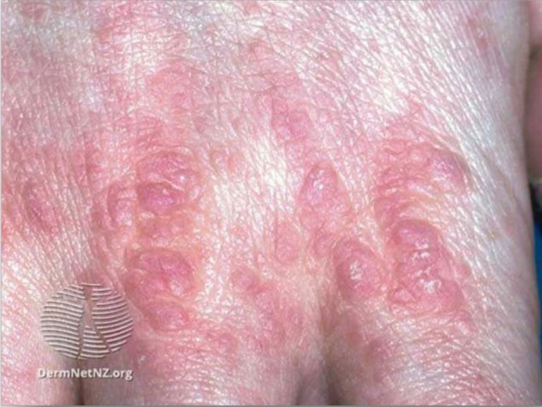 ΠΑΡΑΝΕΟΠΛΑΣΜΑΤΙΚΗ ΠΕΜΦΙΓΑ - Αυγερινού Γεωργία Δερματολόγος ...